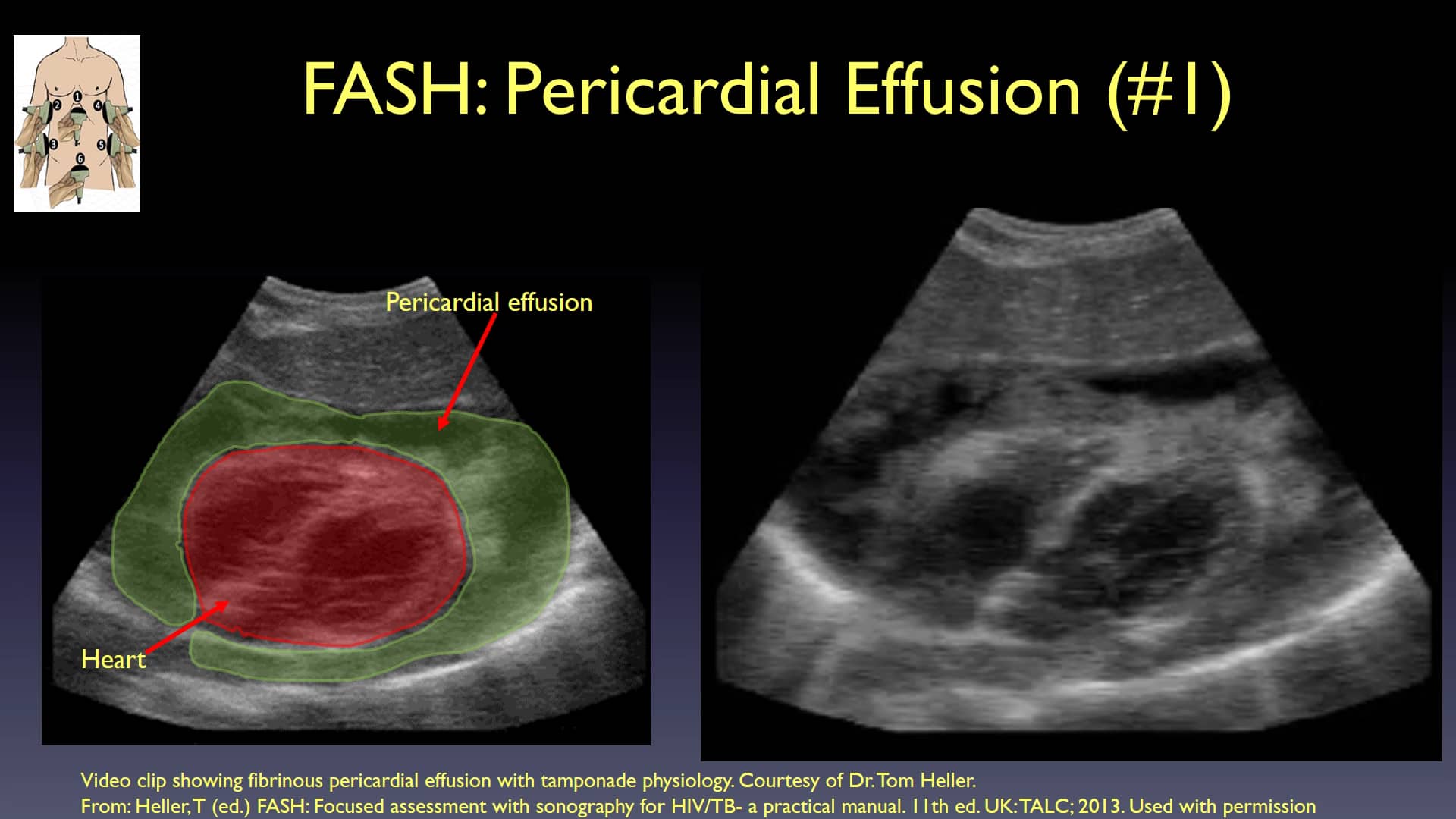 The FASH Exam - Global Health on Vimeo