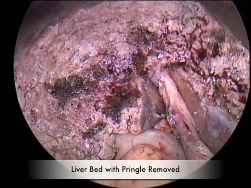 Cirugía del hígado - BOWA MEDICAL