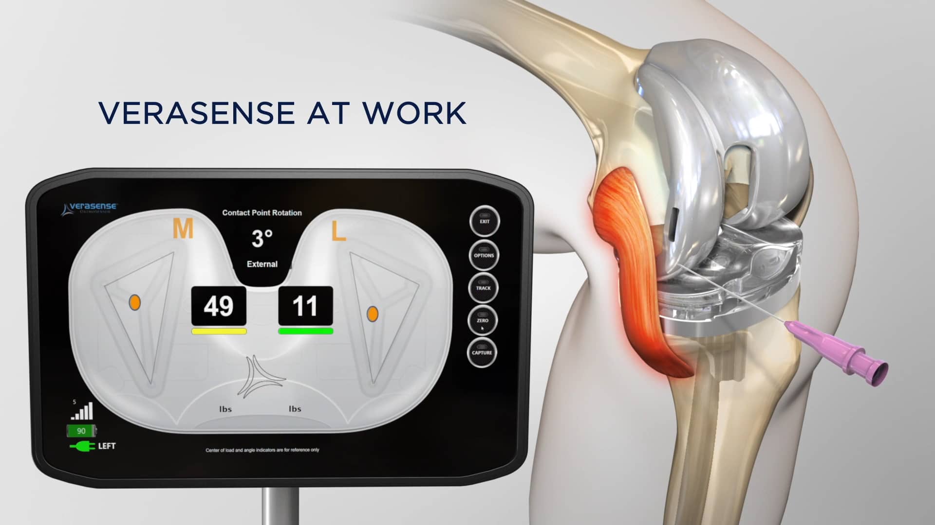 VERASENSE at Work: Clinical and Economic Benefits on Vimeo