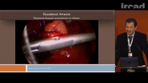 Laparoscopic duodenal atresia repair | WebSurg, the online university ...