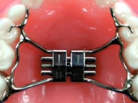 High-Palate (R.P.E.) Hyrax Appliance, Palate Expander, Dental Tools ...