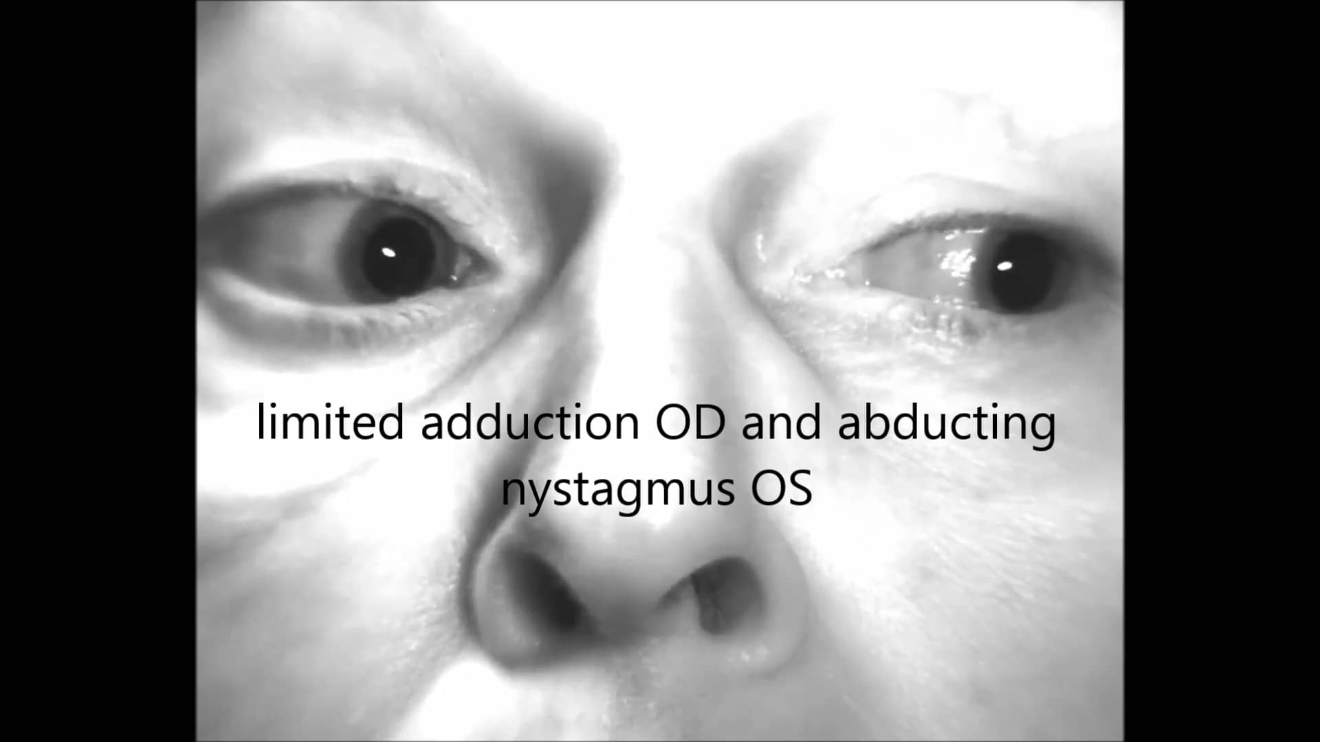 Limited adduction OD and abducting nystagmus OS on Vimeo