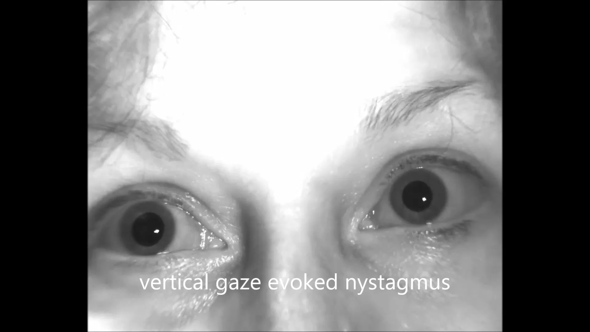 Vertical gaze evoked nystagmus