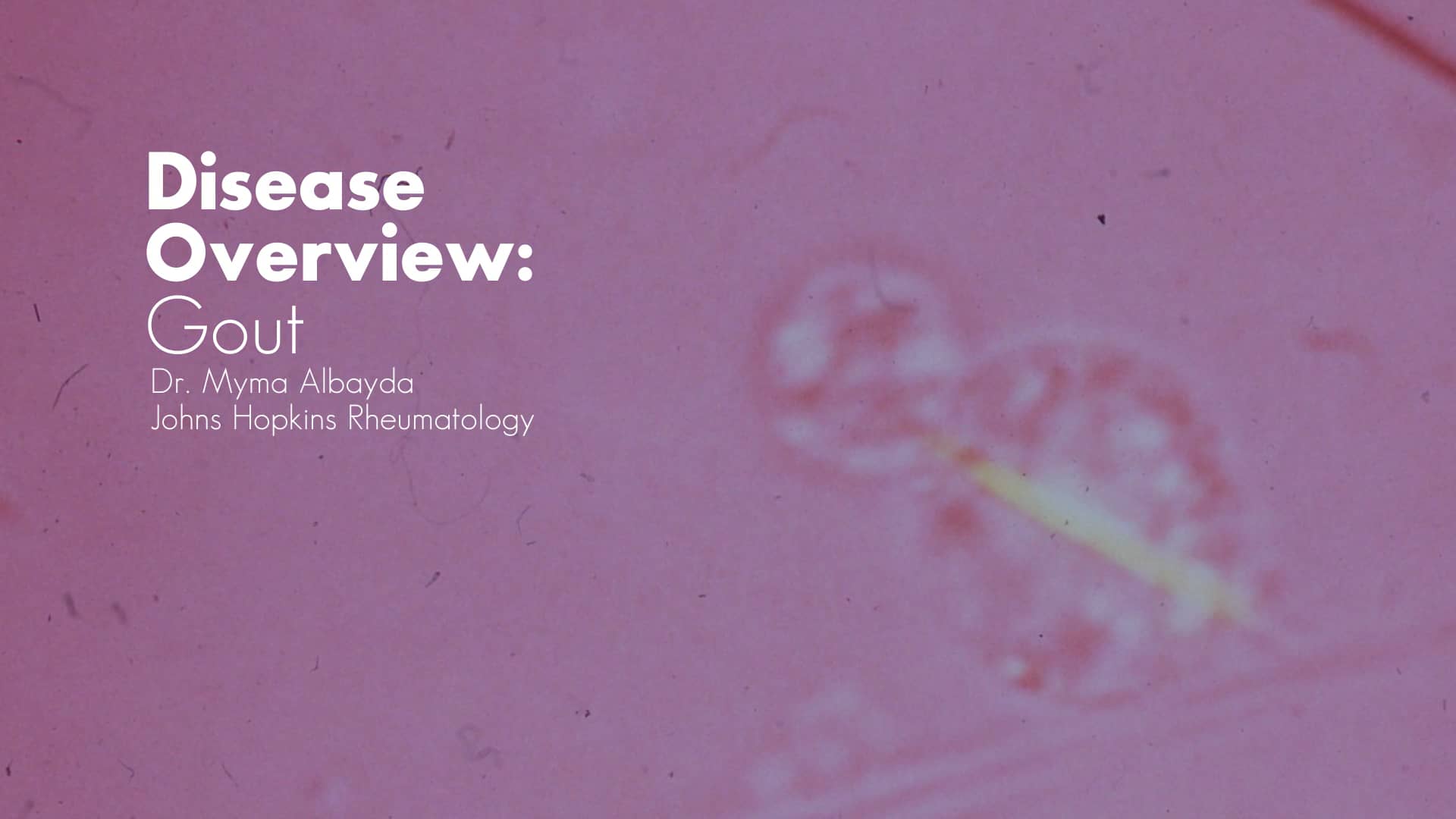 An Overview on Gout on Vimeo