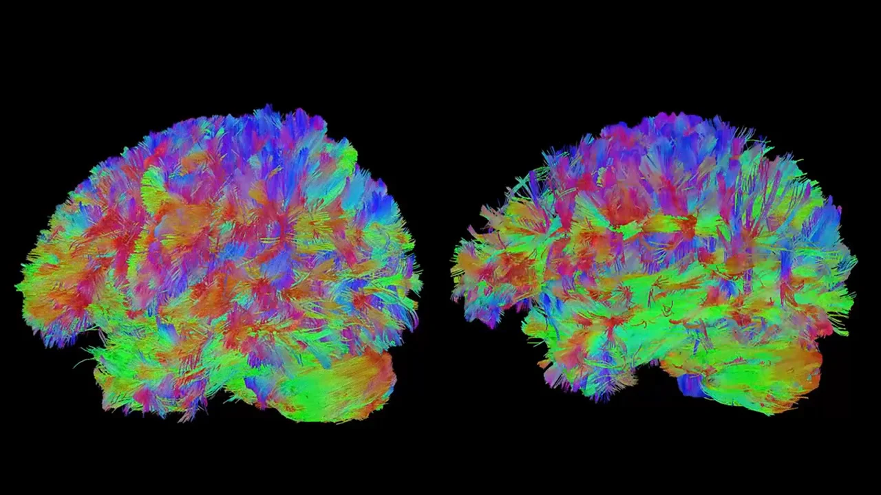Control-v-CVI_MRI_HARDIBrain_HARDIpath