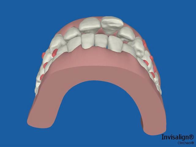 Invisalign overbite animation on Vimeo