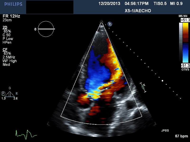 Color Doppler Severe AI 5ch on Vimeo