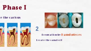 Endodontic Treatment Step Back Technique Using K & H files on Vimeo