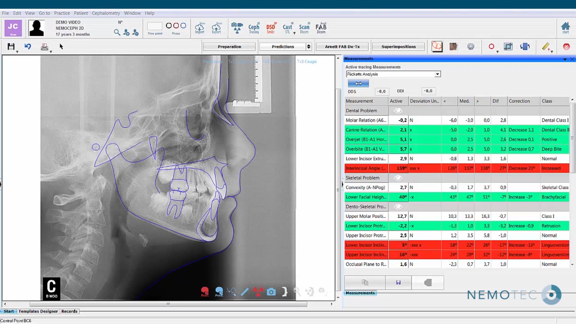 Video DEMO NemoCeph Cephalometric Analysis. Long Version on Vimeo