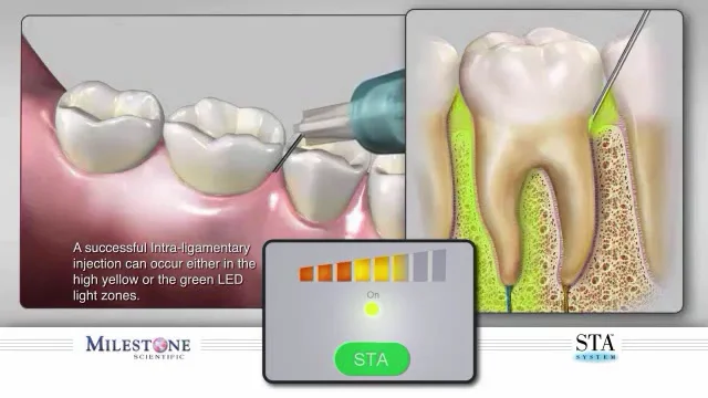 01 STA–Intraligamentary (PDL injection) on Vimeo