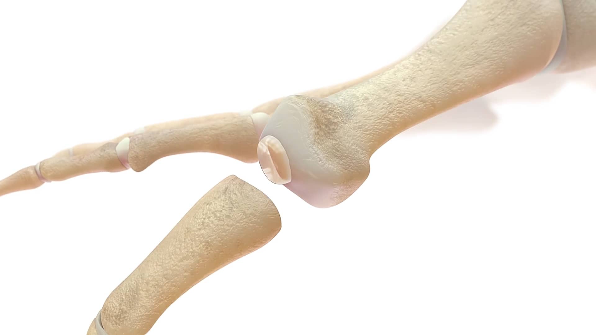 1st MTP Animated Procedure on Vimeo