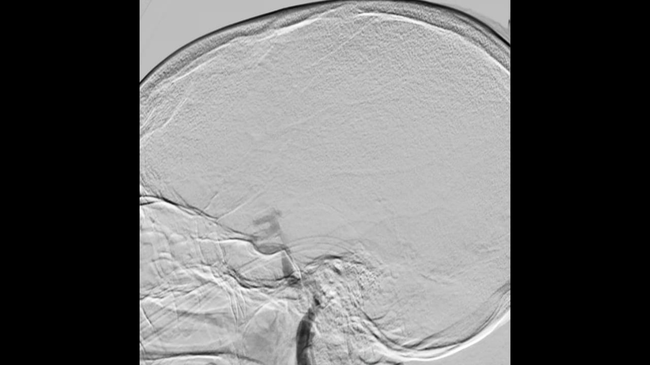 Right CCA, Lateral view on Vimeo