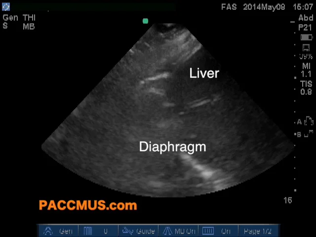 Lung Ultrasound Weak Diaphragm on Vimeo