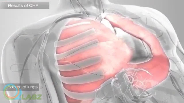Congestive Heart Failure on Vimeo