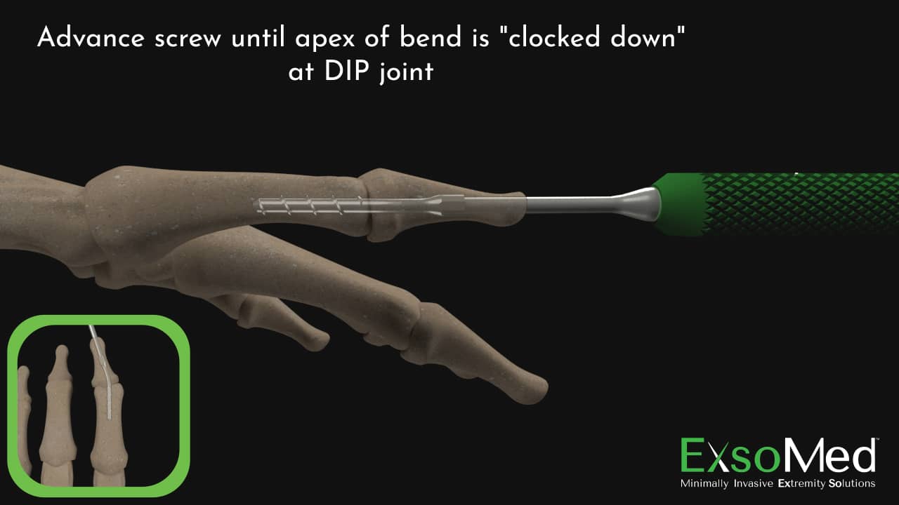 ExsoMed ArcPhix Surgical Animation on Vimeo