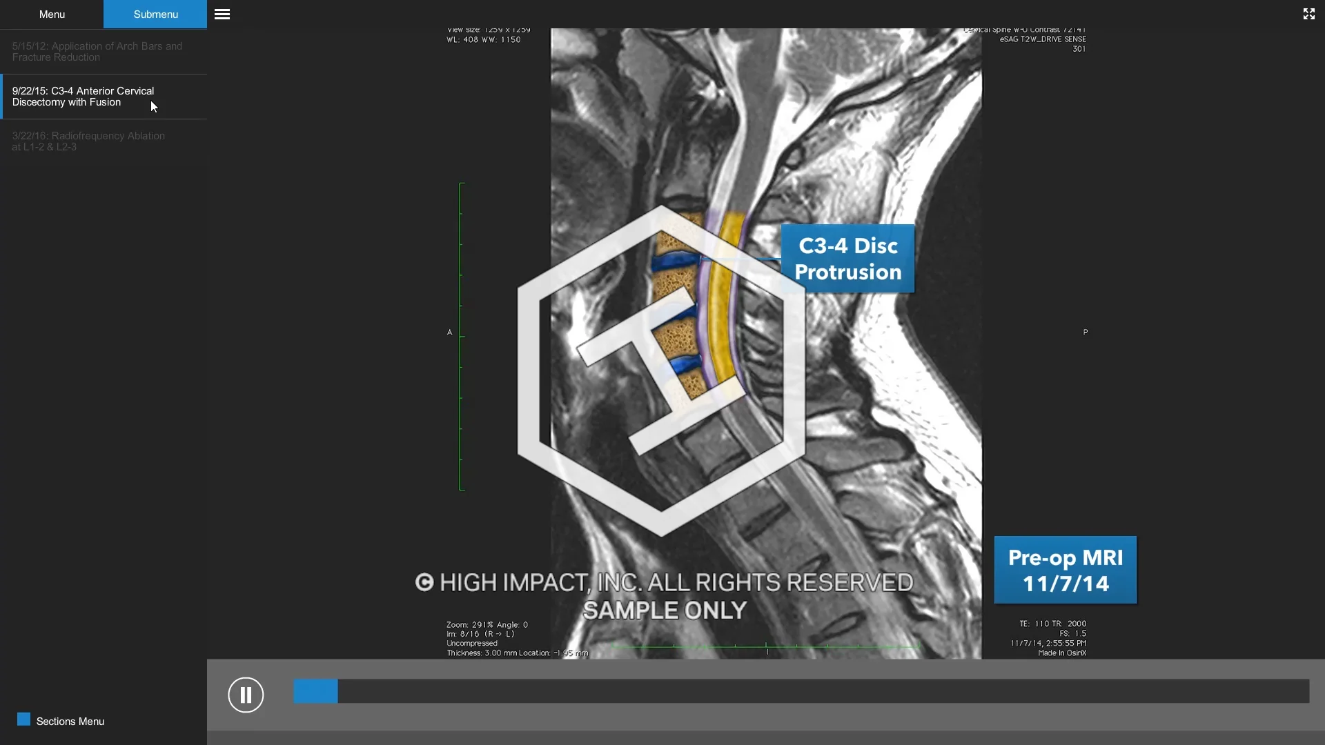 Cervical Surgery Animation on Vimeo