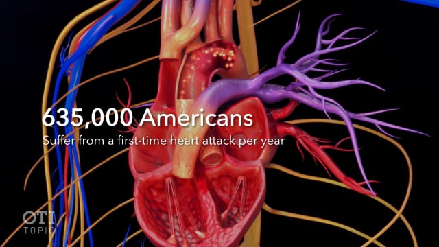 OtiTopic Granted Two Patents Covering its Dry Powder Inhaled Aspirin ...