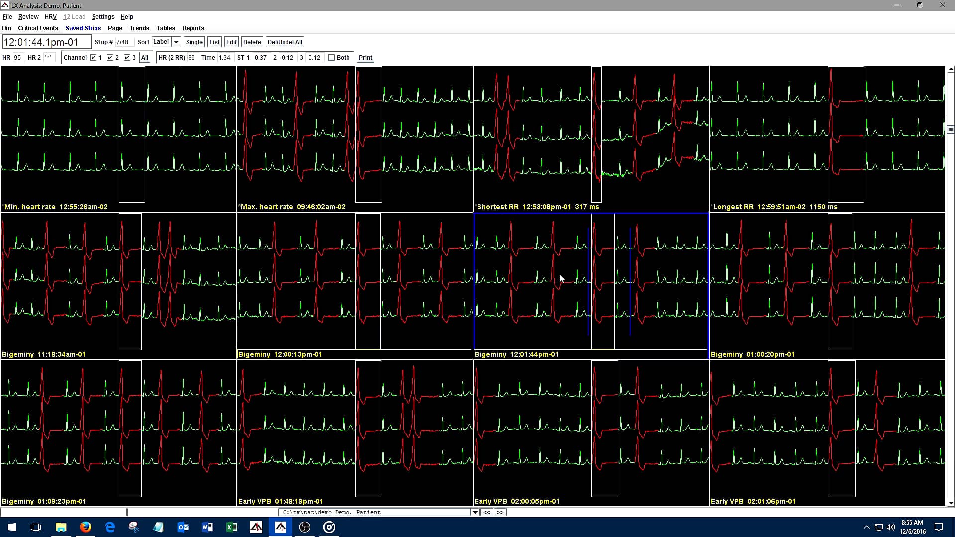 HE/LX Holter Analysis Chapter 4. Review by Saved Strips on Vimeo