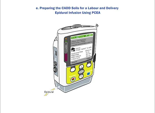 Prepare the CADD Solis for a continuous Epidural infusion using PCEA on ...