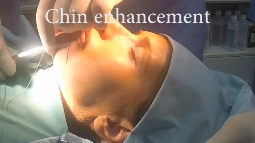 Watch Chin Enhancement via Serdev Suture® method. Instructional video ...
