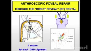 Foveal fixation of TFCC tears | WebSurg, the online university of IRCAD