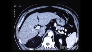 Laparoscopic right adrenalectomy | WebSurg, the online university of IRCAD