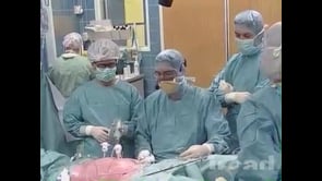 Laparoscopic ileocecal resection for Crohn's disease | WebSurg, the ...