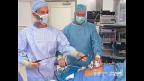 Laparoscopic Nissen fundoplication in children | WebSurg, the online ...