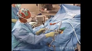 Endoluminal surgery, Transanal Endoscopic Microsurgery (TEM): resection ...