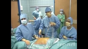 Laparoscopic sigmoidectomy for sigmoid diverticulitis in a female ...