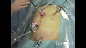 Laparoscopic sigmoidectomy with initial splenic flexure mobilization ...