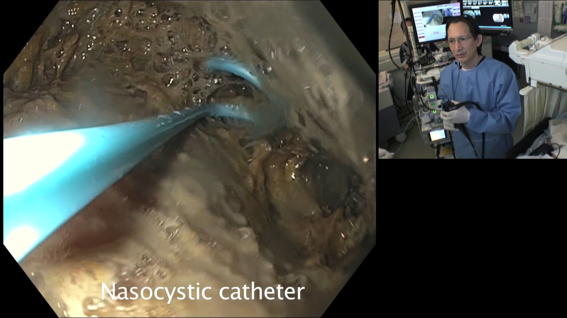 WON management: AXIOS + 7 Fr Nasocystic catheter drainage on Vimeo