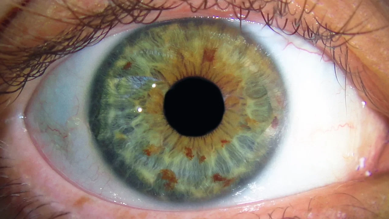 Are strong minus glasses for nearsightedness causing Stress?