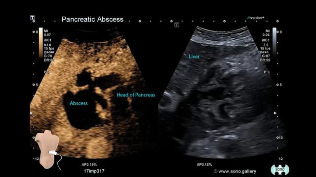 Pancreatic Abscess Ultrasound