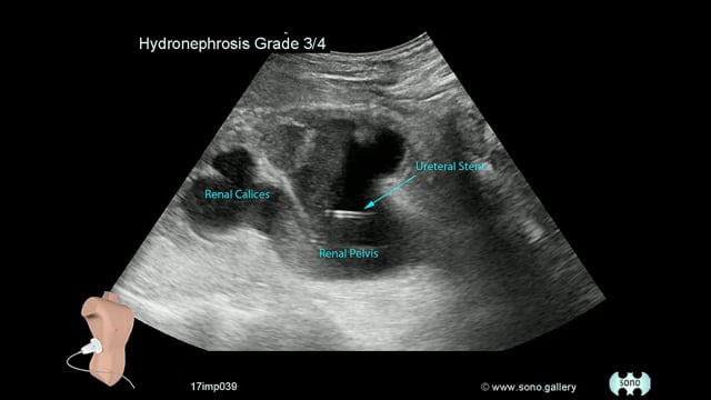Hydronephrosis Grade 2/3, Ureteral Stent - SONO.GALLERY