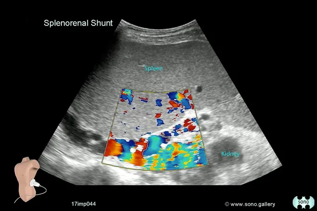 Splenorenal Shunt Ultrasound