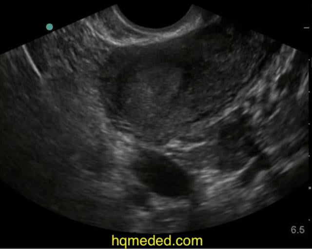 Ultrasonography - early IUP on Vimeo