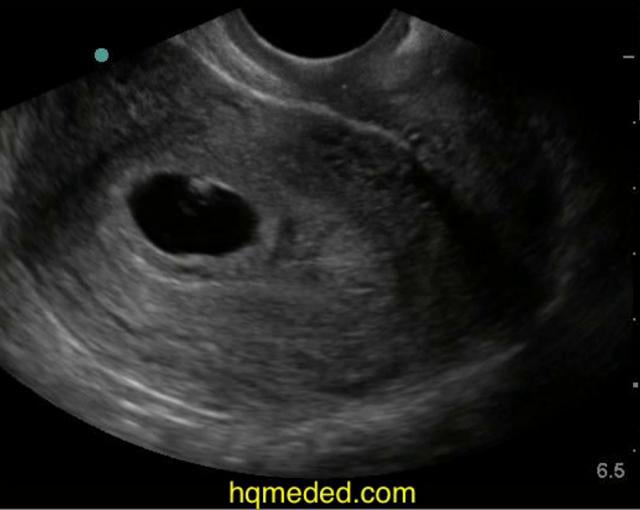 Ultrasonography - early IUP on Vimeo