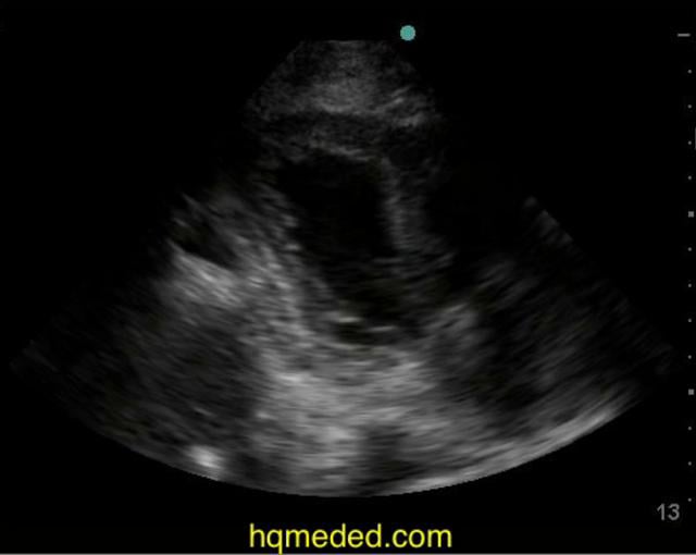Ultrasonography - free fluid in pelvis on Vimeo