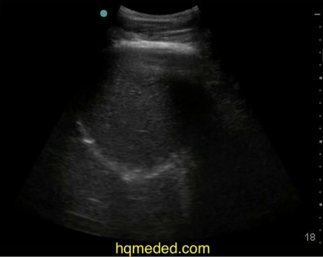 Ultrasonography - negative FAST on Vimeo