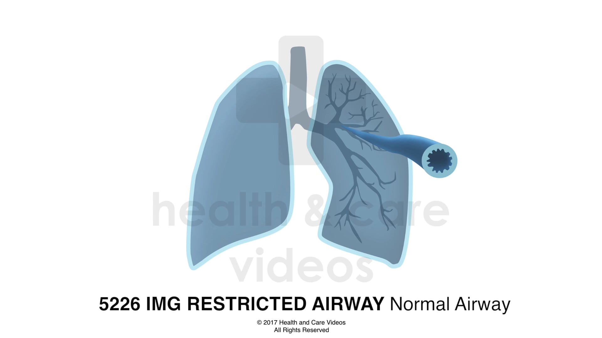 HCV Clip library Animation & Assets - 5226 IMG RESTRICTED AIRWAY Normal ...
