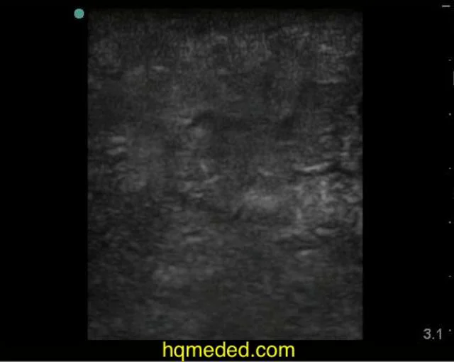 Ultrasonography - cobblestoning on Vimeo
