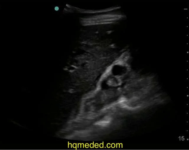 Ultrasonography - forniceal rupture on Vimeo