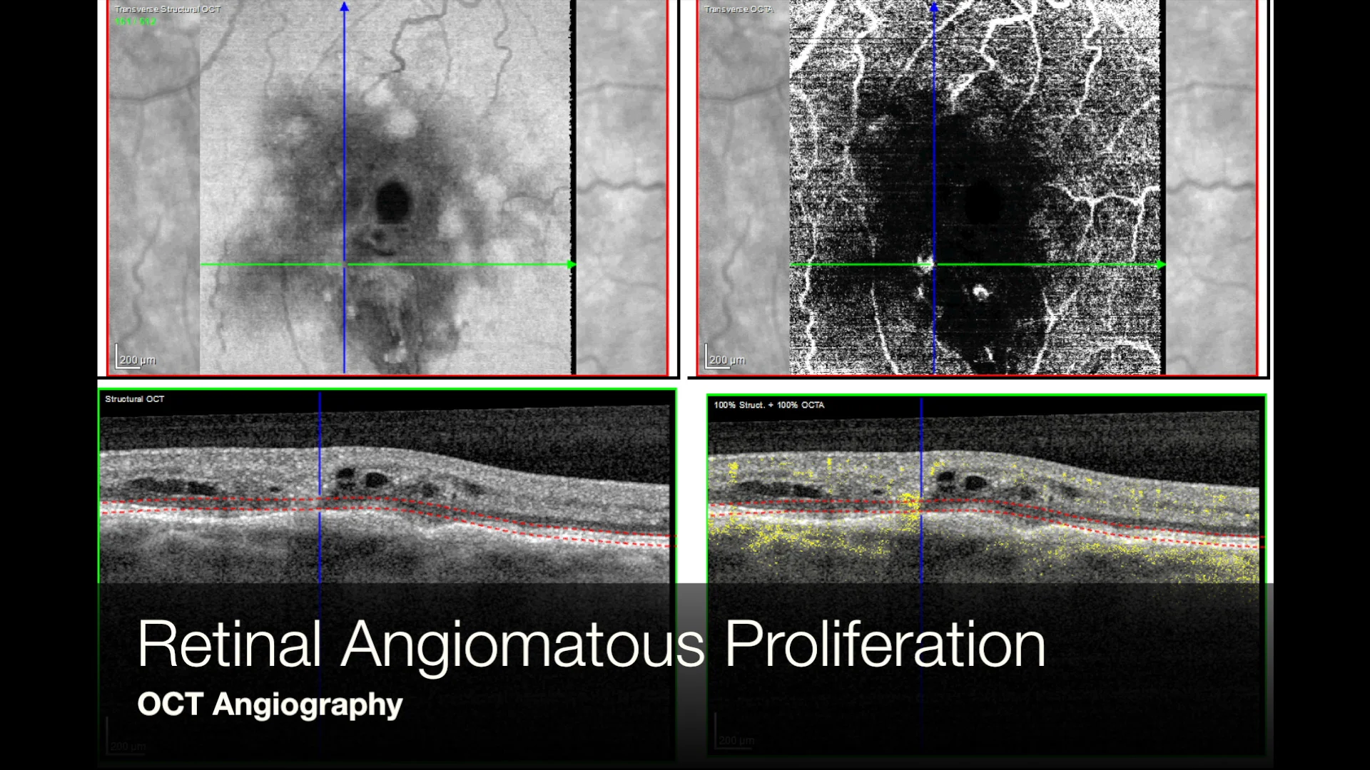 OCTA Showing RAP Lesion