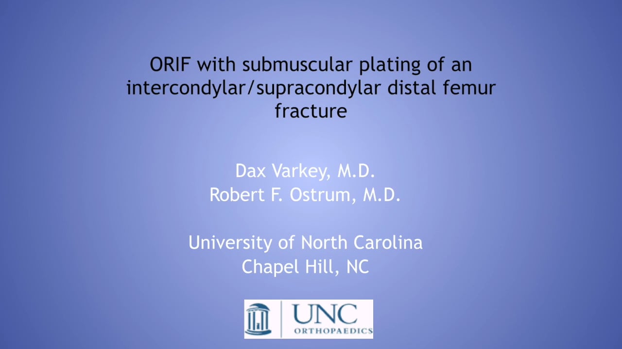 OTA Video Library - Supracondylar Femur Fracture ORIF - Ostrum on Vimeo