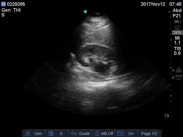 Extrarenal Pelvis Ultrasound
