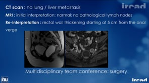 Laparoscopic low anterior resection in a patient with low rectal cancer ...