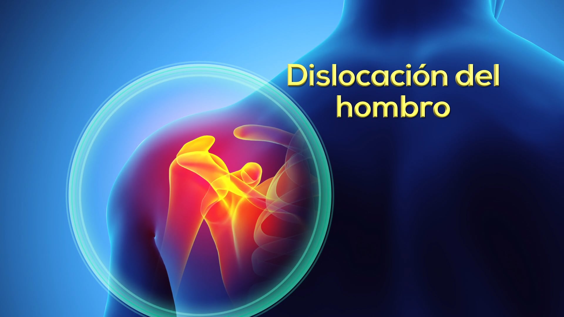Dislocación del hombro por Dr. Luis Fernando Amado - SaludPanama.com on ...