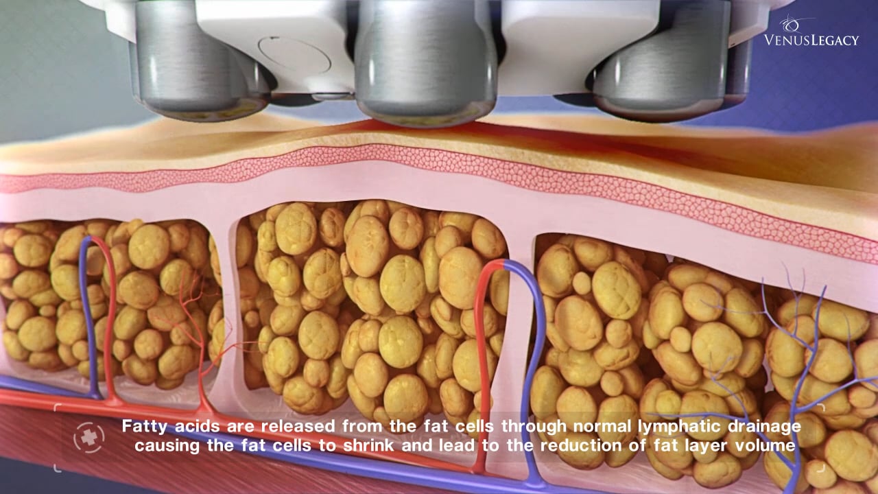 Athenix Body Sculpting Institute - Venus Legacy on Vimeo