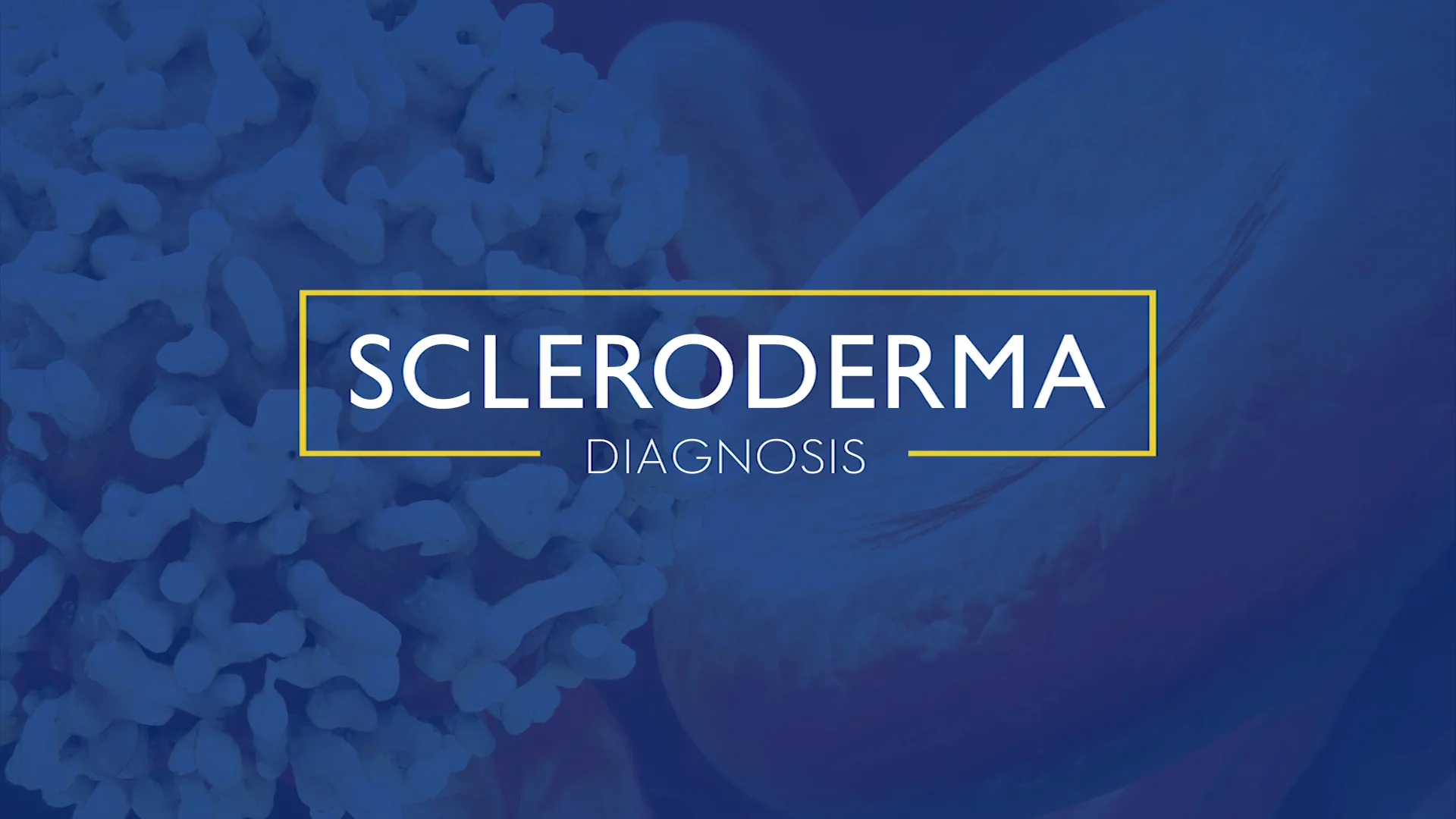 Diagnosing Scleroderma | Johns Hopkins on Vimeo